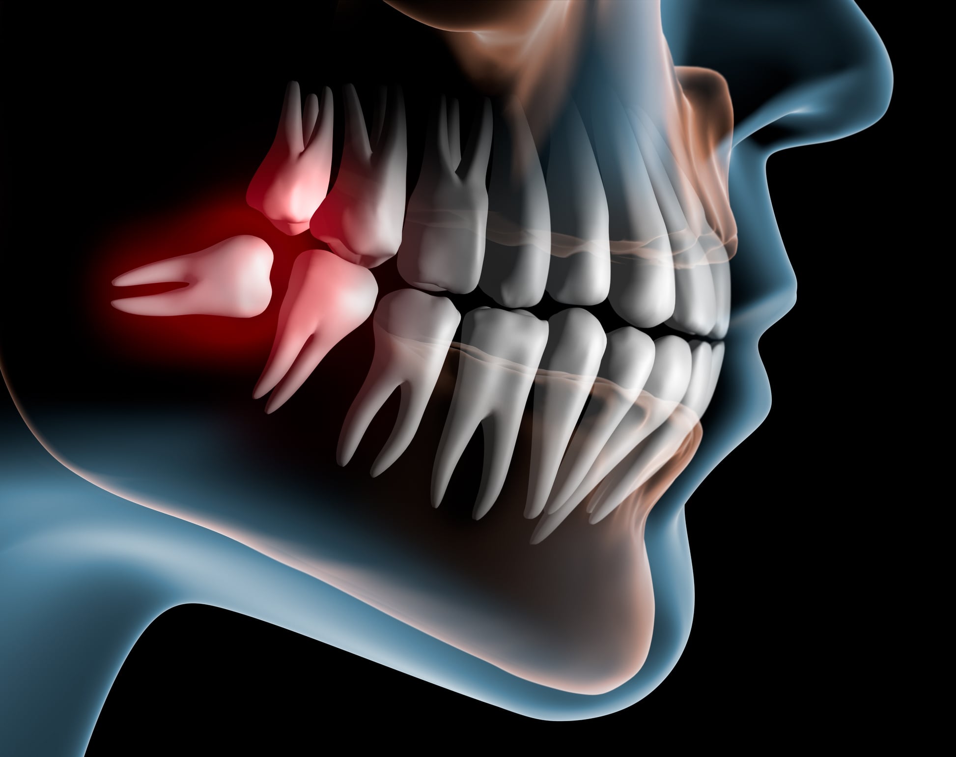 Wisdom Teeth Removal - Peak Dental - Bartow, Florida